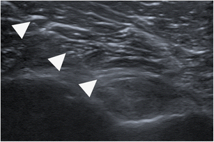 Ultrasound-Guided Percutaneous Long Head of the Biceps Tenotomy: a ...