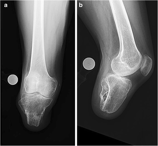Lengthening of Tibia after Trans-Tibial Amputation: Use of a Weight ...