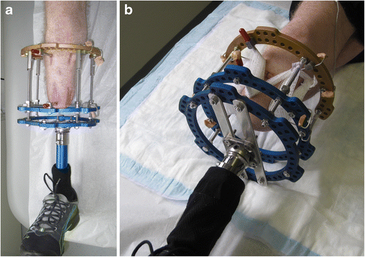 Lengthening of Tibia after Trans-Tibial Amputation: Use of a Weight ...