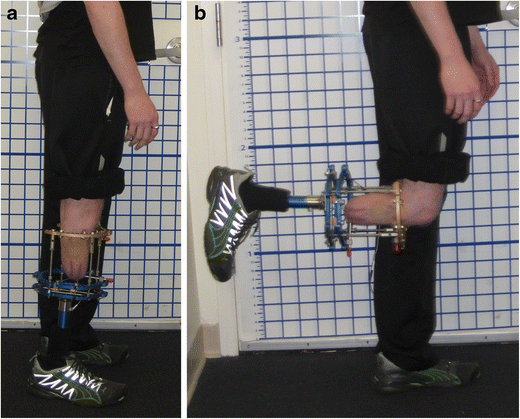 Lengthening of Tibia after Trans-Tibial Amputation: Use of a Weight ...