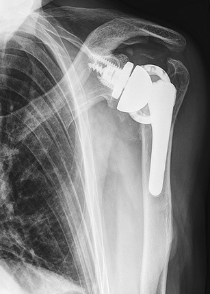 Humeral Tray-Taper Failure in Modular Reverse Total Shoulder ...