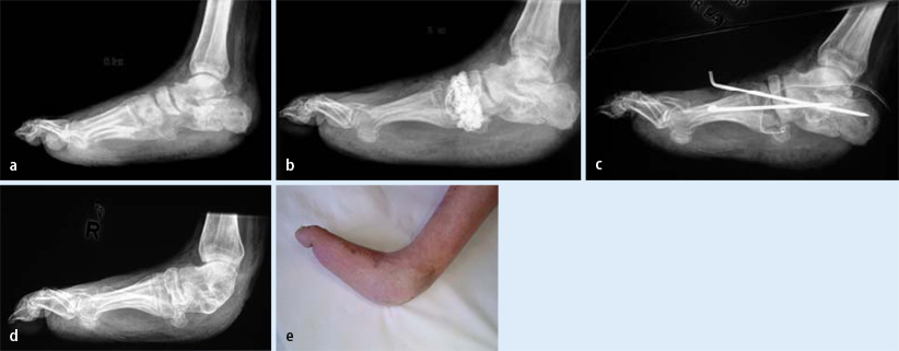 Innere Amputationen beim diabetischen Fußsyndrom | SpringerLink