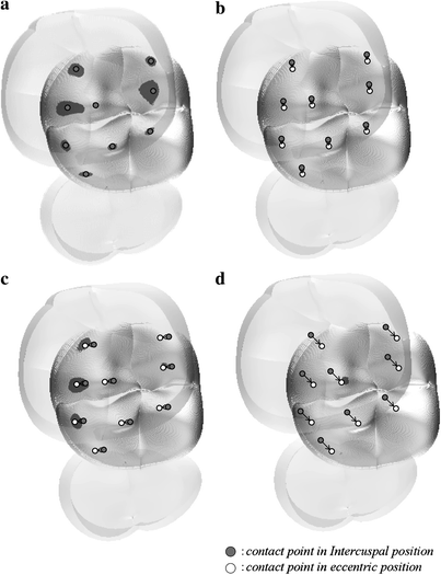 Computer-aided determination of occlusal contact points for dental 3-D ...