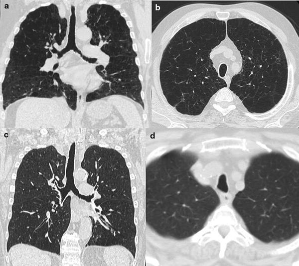 Saber-sheath trachea as a marker of severe airflow obstruction in ...