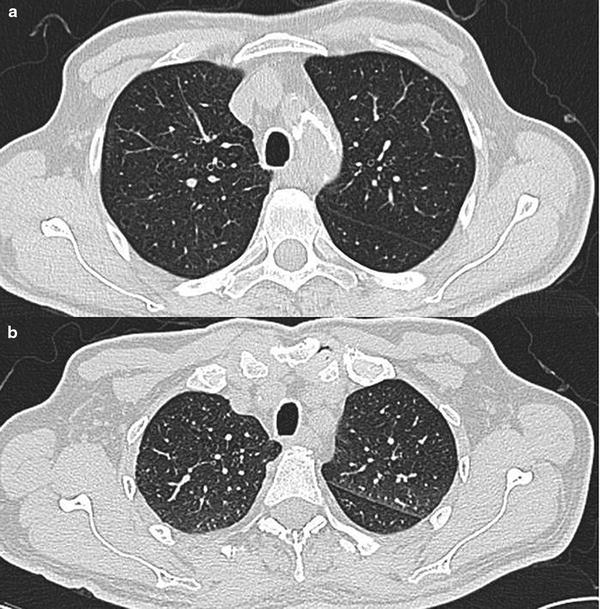 Saber-sheath trachea as a marker of severe airflow obstruction in ...