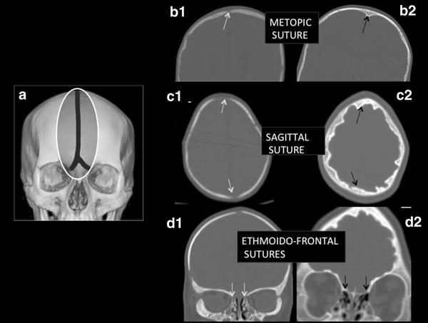 Identification of skull base sutures and craniofacial anomalies in ...