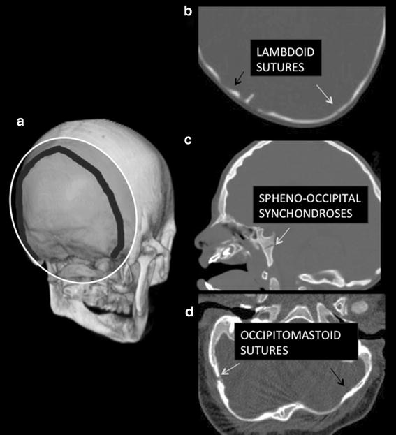 Identification of skull base sutures and craniofacial anomalies in ...