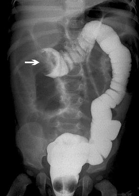 Fluoroscopy-guided hydrostatic reduction of intussusception in infancy ...
