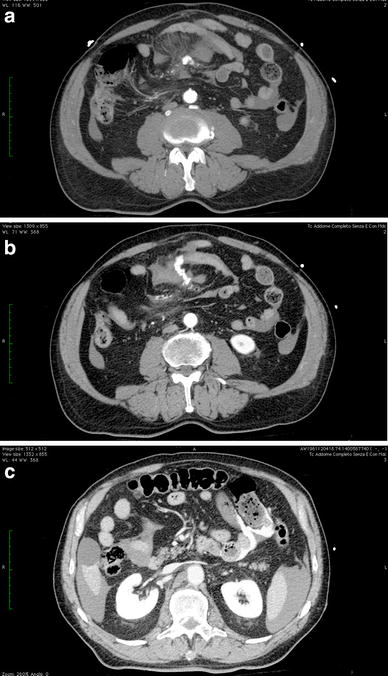 Bowel and mesenteric injuries from blunt abdominal trauma: a review ...