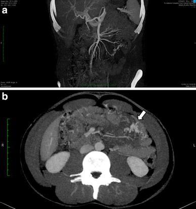 Bowel and mesenteric injuries from blunt abdominal trauma: a review ...