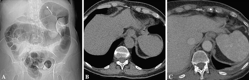 Incidental physiological sliding hiatal hernia: a single center ...