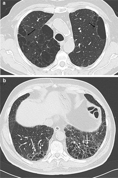 Combined pulmonary fibrosis and emphysema (CPFE): what radiologist ...