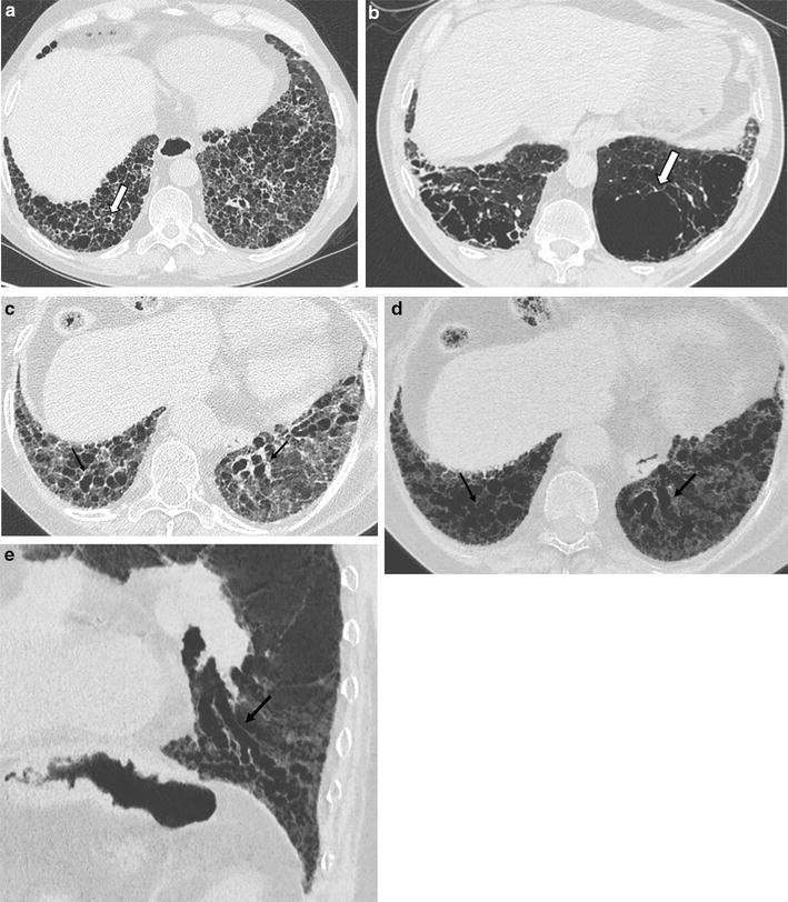 Combined pulmonary fibrosis and emphysema (CPFE): what radiologist ...