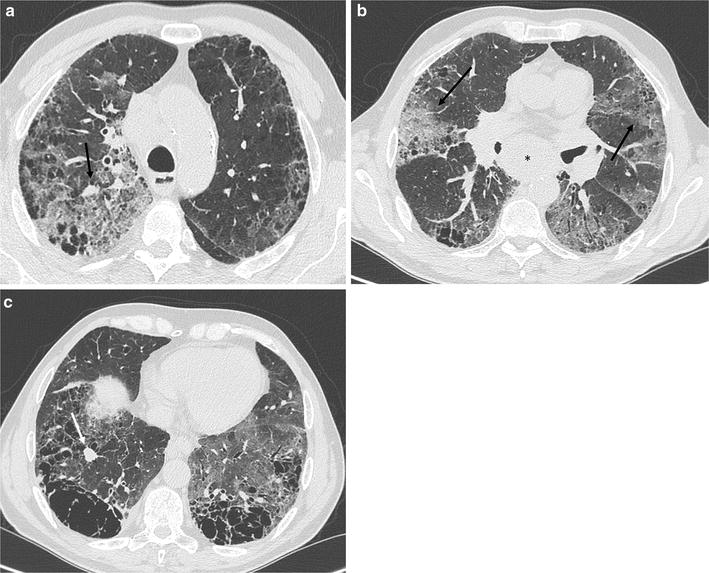 Combined pulmonary fibrosis and emphysema (CPFE): what radiologist ...