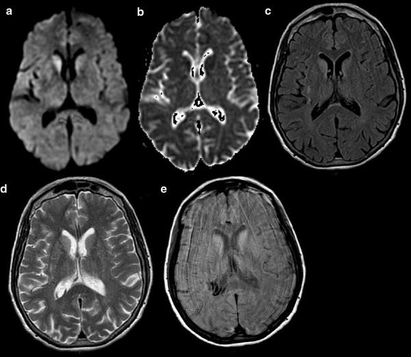 Neuroradiology of human prion diseases, diagnosis and differential ...