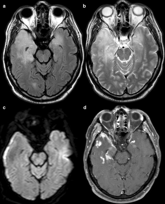 Neuroradiology of human prion diseases, diagnosis and differential ...