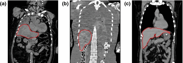 Automated liver segmentation from a postmortem CT scan based on a ...