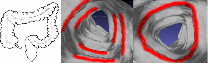 Haustral loop extraction for CT colonography using geodesics | SpringerLink