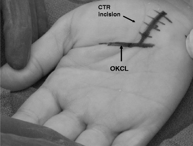 The Clinical Application of Kaplan’s Cardinal Line as a Surface Marker ...