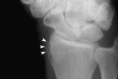 Does Radial Styloid Abnormality in de Quervain’s Disease Affect the ...