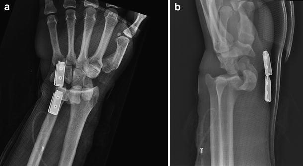 Proximal carpal row dislocation: a case report | SpringerLink