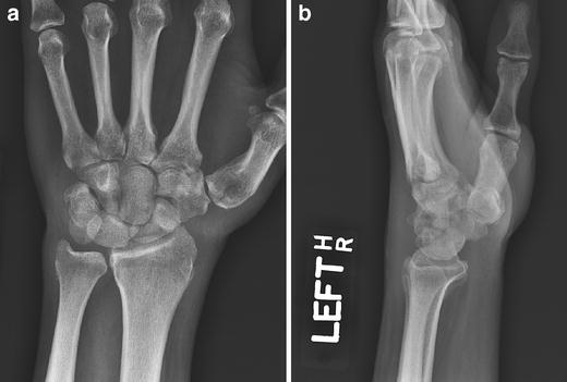 Proximal carpal row dislocation: a case report | SpringerLink