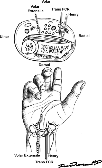 Surgical approaches to the distal radius | SpringerLink
