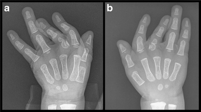 Bilateral proximal delta phalanges: an unusual presentation of familial ...