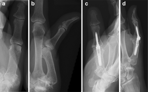 MCP arthrodesis using an intramedullary interlocking device | SpringerLink