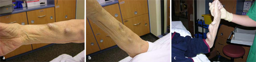 Stenosen des Hämodialyse-Shunts | SpringerLink