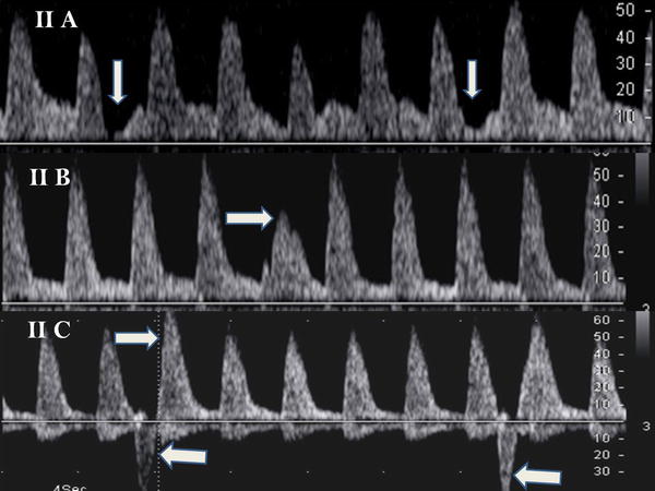 A classification of patterns of fetal middle cerebral artery velocity ...