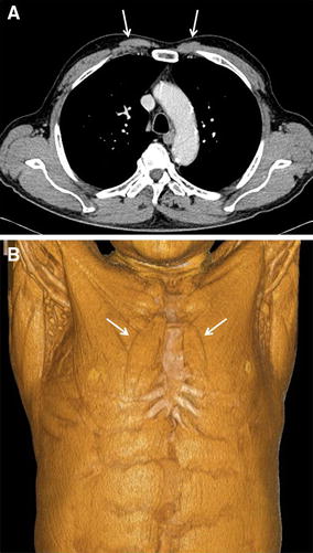 The sternalis muscle: radiologic findings on MDCT | SpringerLink