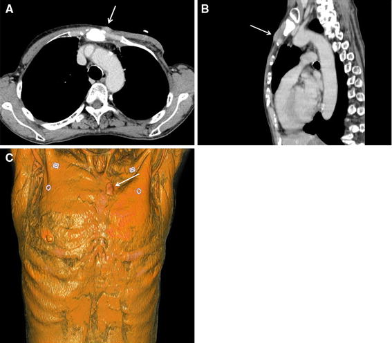 The sternalis muscle: radiologic findings on MDCT | SpringerLink