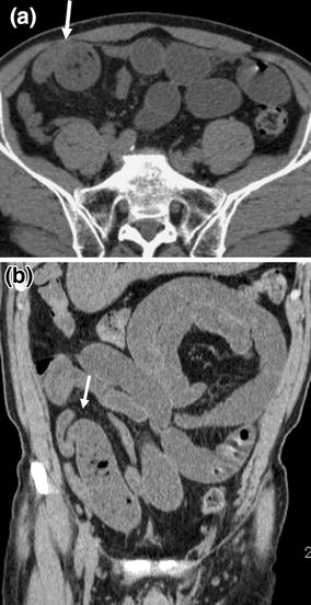 Multidetector CT appearance of adhesion-induced small bowel ...