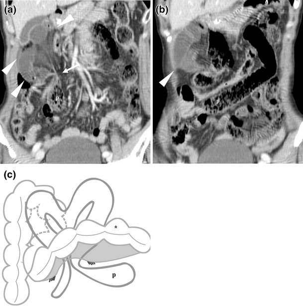 Multidetector CT appearance of adhesion-induced small bowel ...