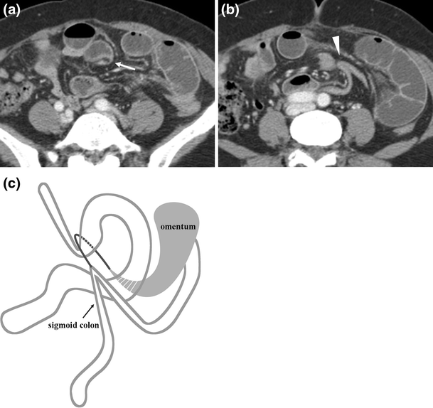 Multidetector CT appearance of adhesion-induced small bowel ...