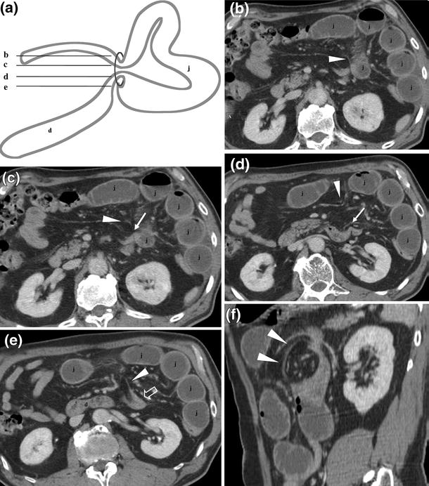 Multidetector CT appearance of adhesion-induced small bowel ...