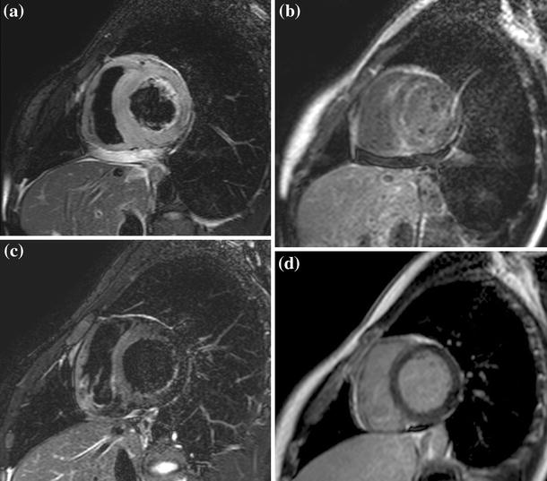 T2-weighted and delayed enhancement MRI of eosinophilic myocarditis ...
