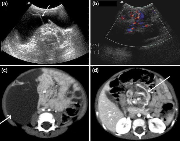Mesenteric cysts associated with recurrent small-bowel volvulus: cause ...