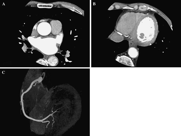 Compact-bolus dynamic CT protocol with a test bolus technique in 64 ...