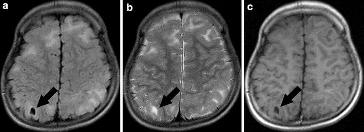 Semi-automatic volumetry of cortical tubers in tuberous sclerosis ...