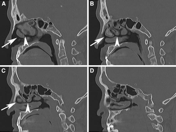 Frontal sinusitis caused by first and second secondary middle ...