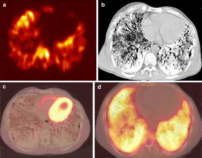 Pulmonary alveolar microlithiasis: imaging characteristics of planar ...