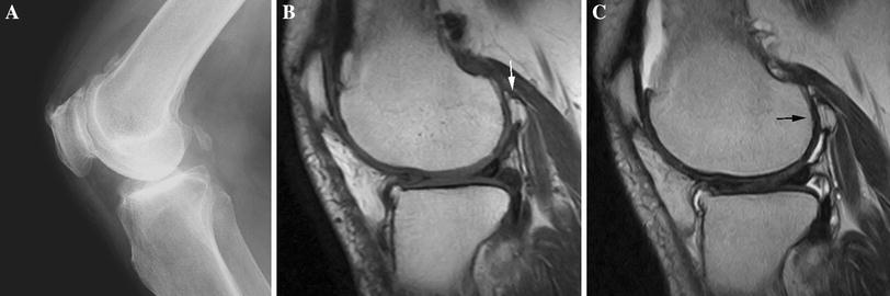 Potentially symptomatic fabella: MR imaging review | SpringerLink