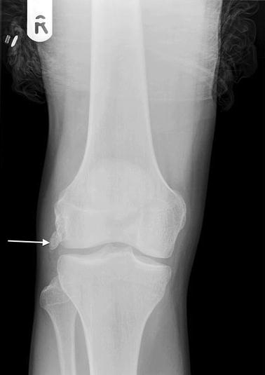 Sesamoiditis of the cyamella: imaging features of this rare ...