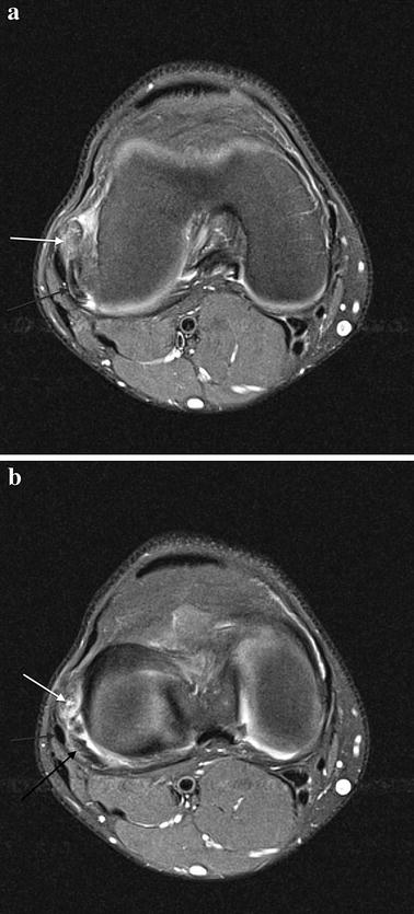 Sesamoiditis of the cyamella: imaging features of this rare ...