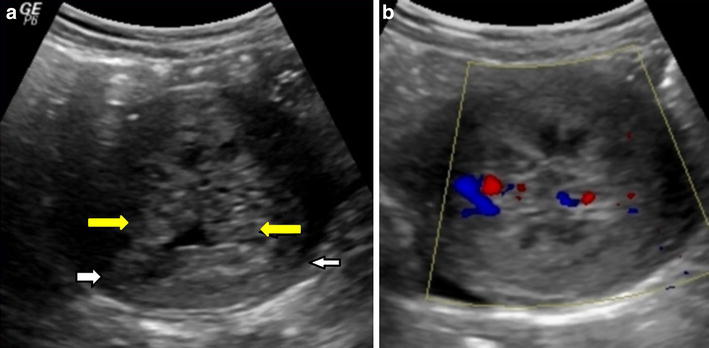 Sonographic and MR features of puerperal uterine inversion | SpringerLink