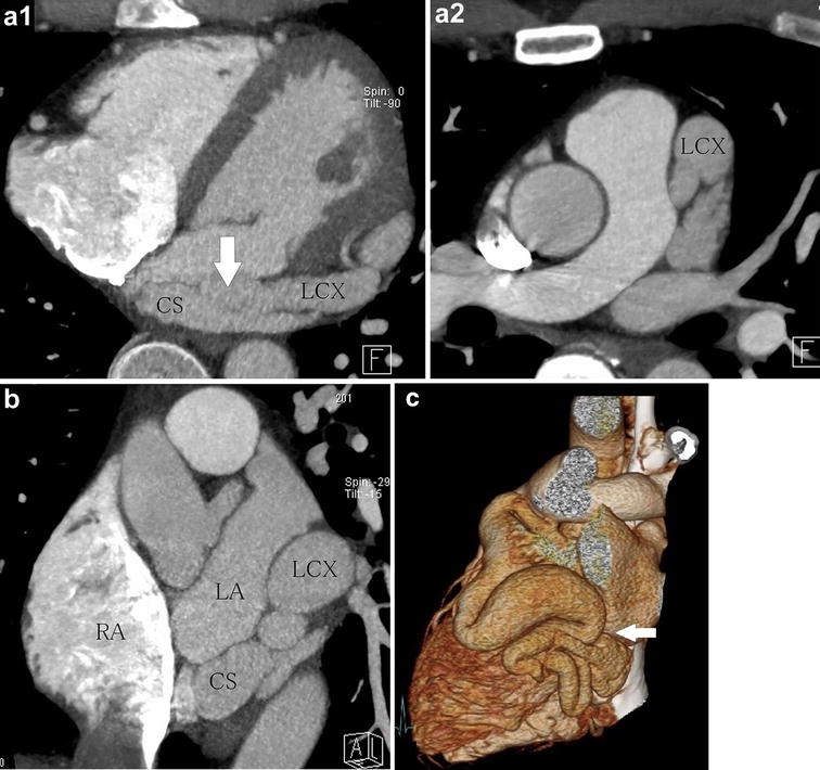 Incidence and appearances of coronary sinus anomalies in adults on ...