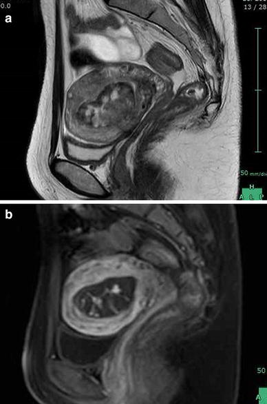Multimodality imaging in secondary postpartum or postabortion ...