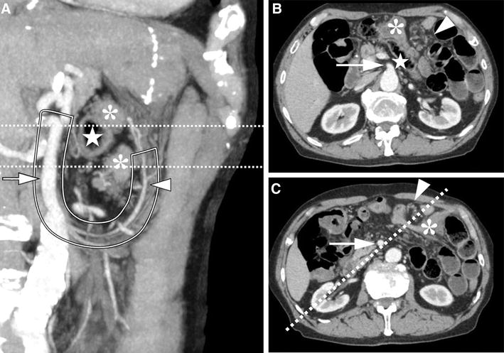 Hooking intestine sign: a typical diagnostic CT finding of Petersen’s ...